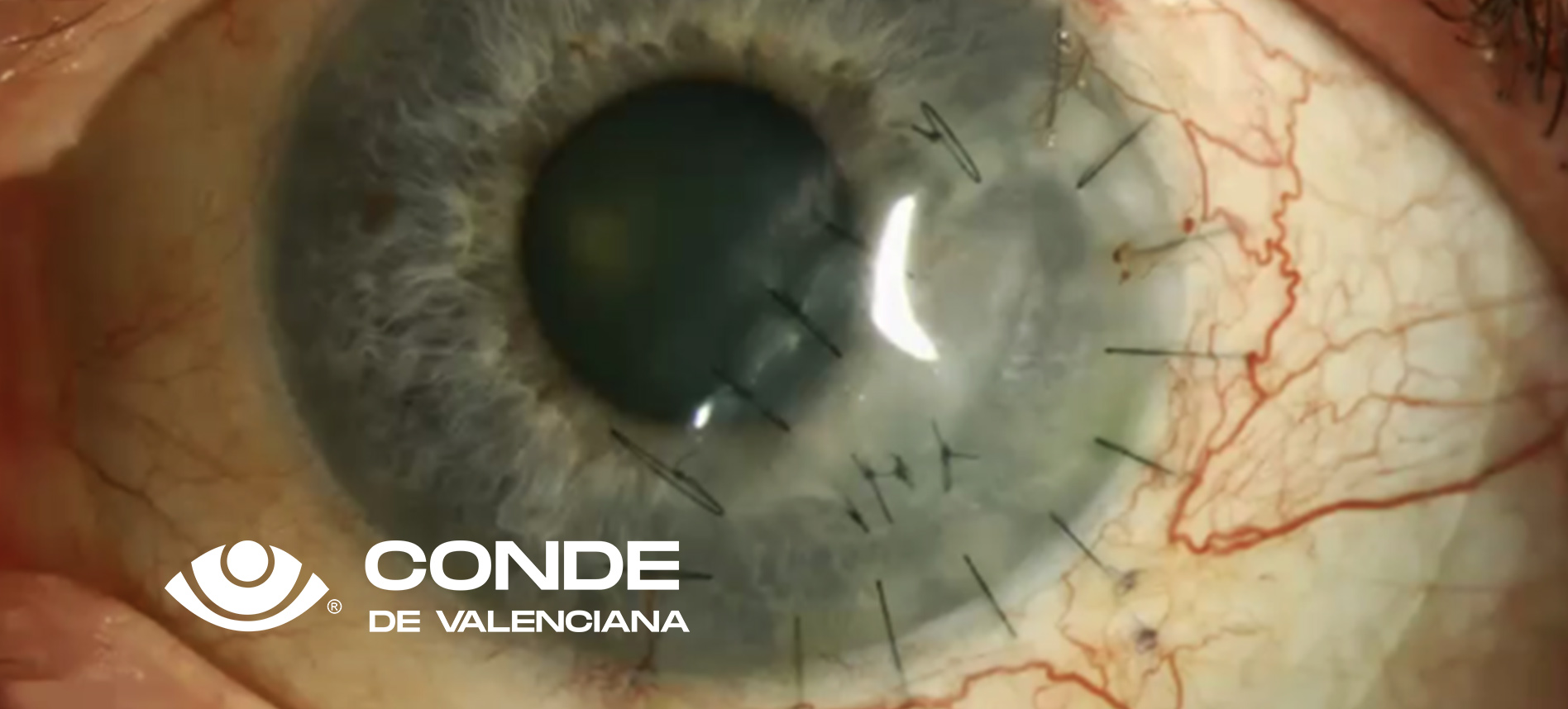 Córnea – Conde Médico