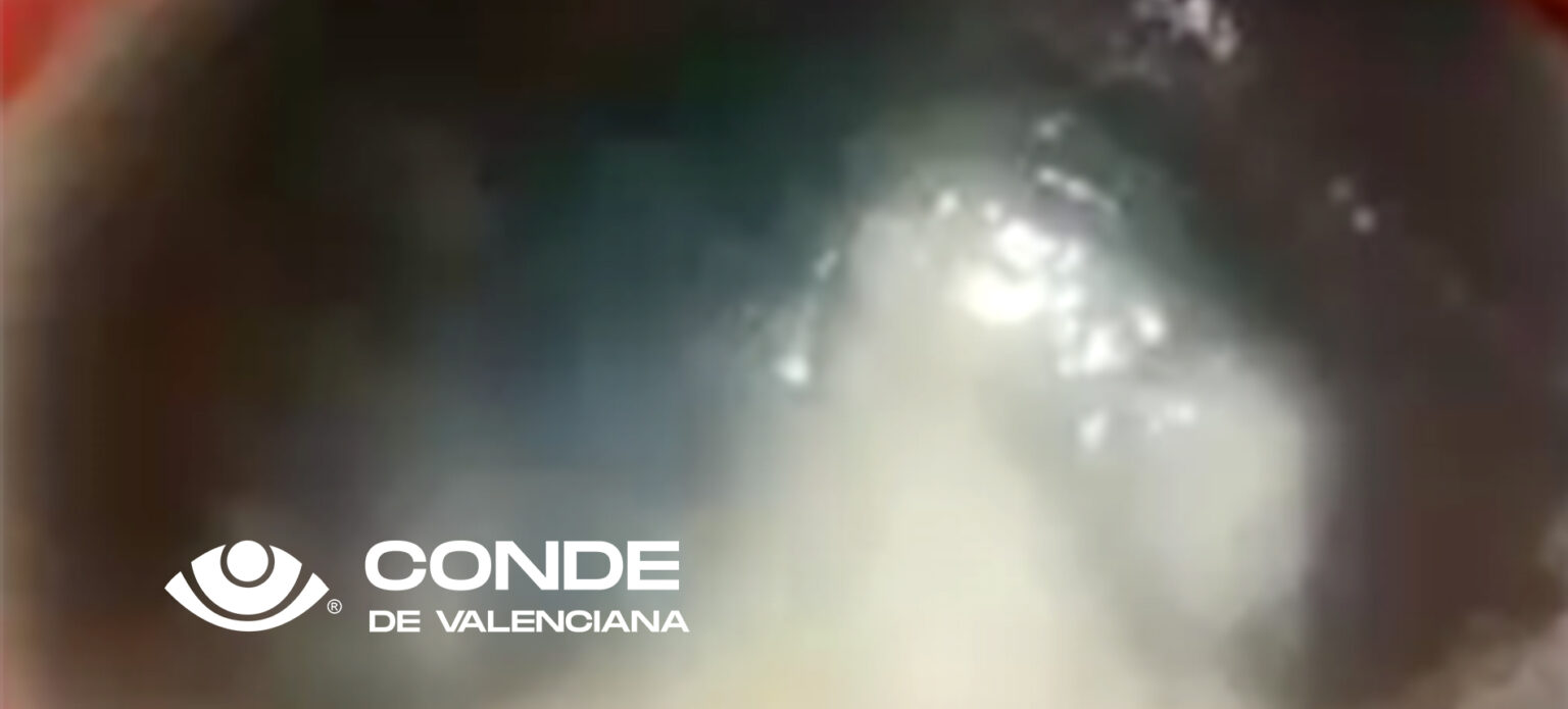 Queratitis infecciosa Bacteriana – Conde Médico